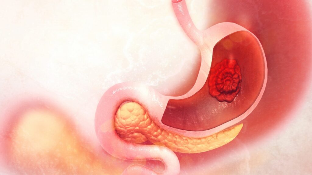 Can Stomach Ulcers Lead to Stomach Cancer